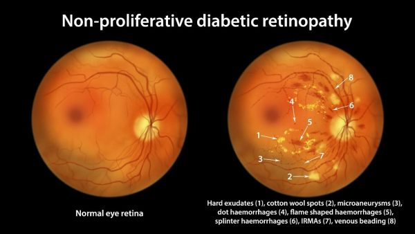 Diabetic retinopathy - Mary River Eye Specialists